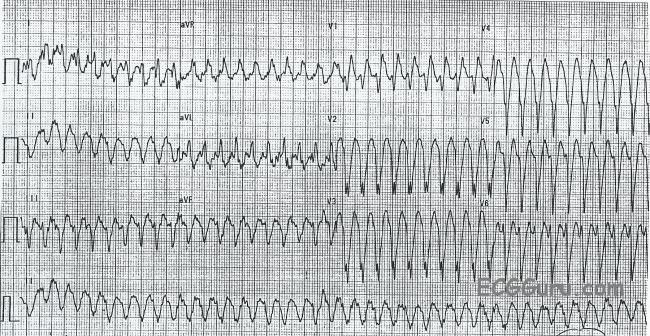 Wide-complex Tachycardia: Ventricular Tachycardia | ECG Guru ... Wide-complex Tachycardia: Ventricular Tachycardia | ECG Guru ...